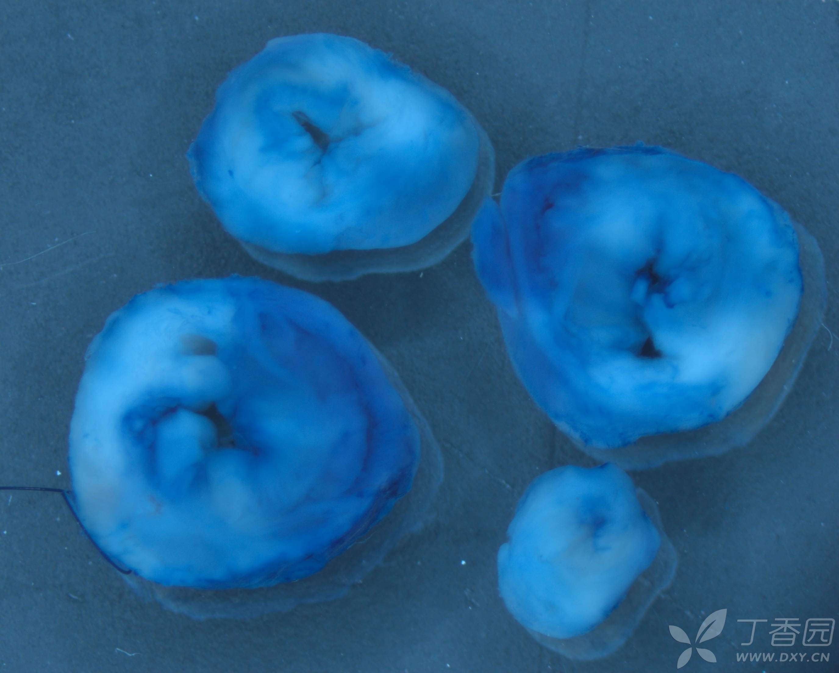 心梗后Evans Blue+TTC染色结果请教 - 丁香园论坛