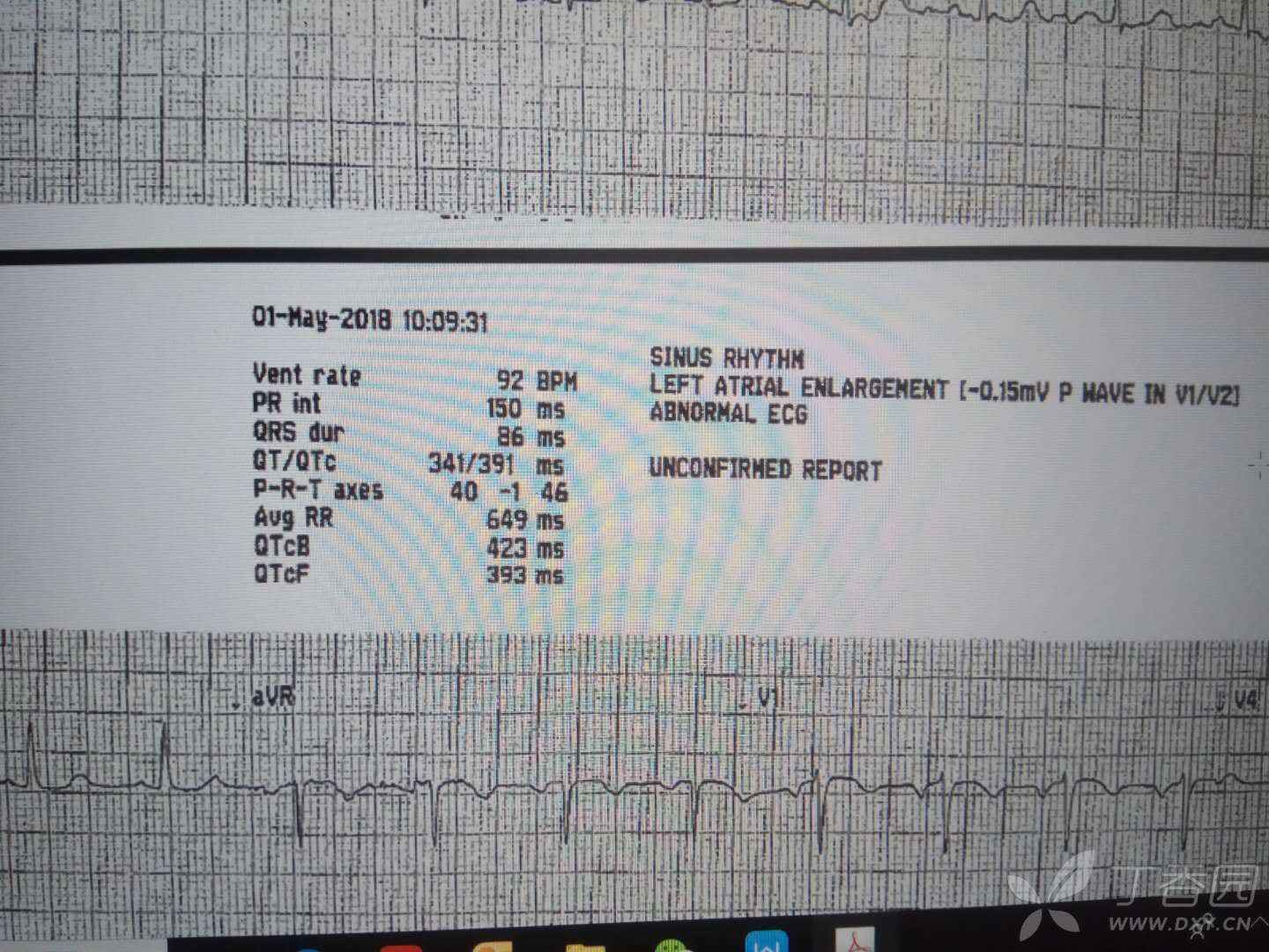 请教一下心电图报告中QT/QTc的QTc是指QTcB还是QTcF? - 丁香园论坛