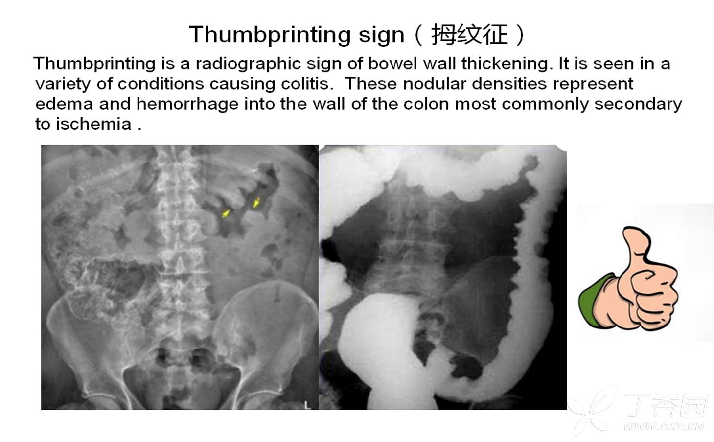 Thumbprinting sign（拇纹征） - 丁香园论坛