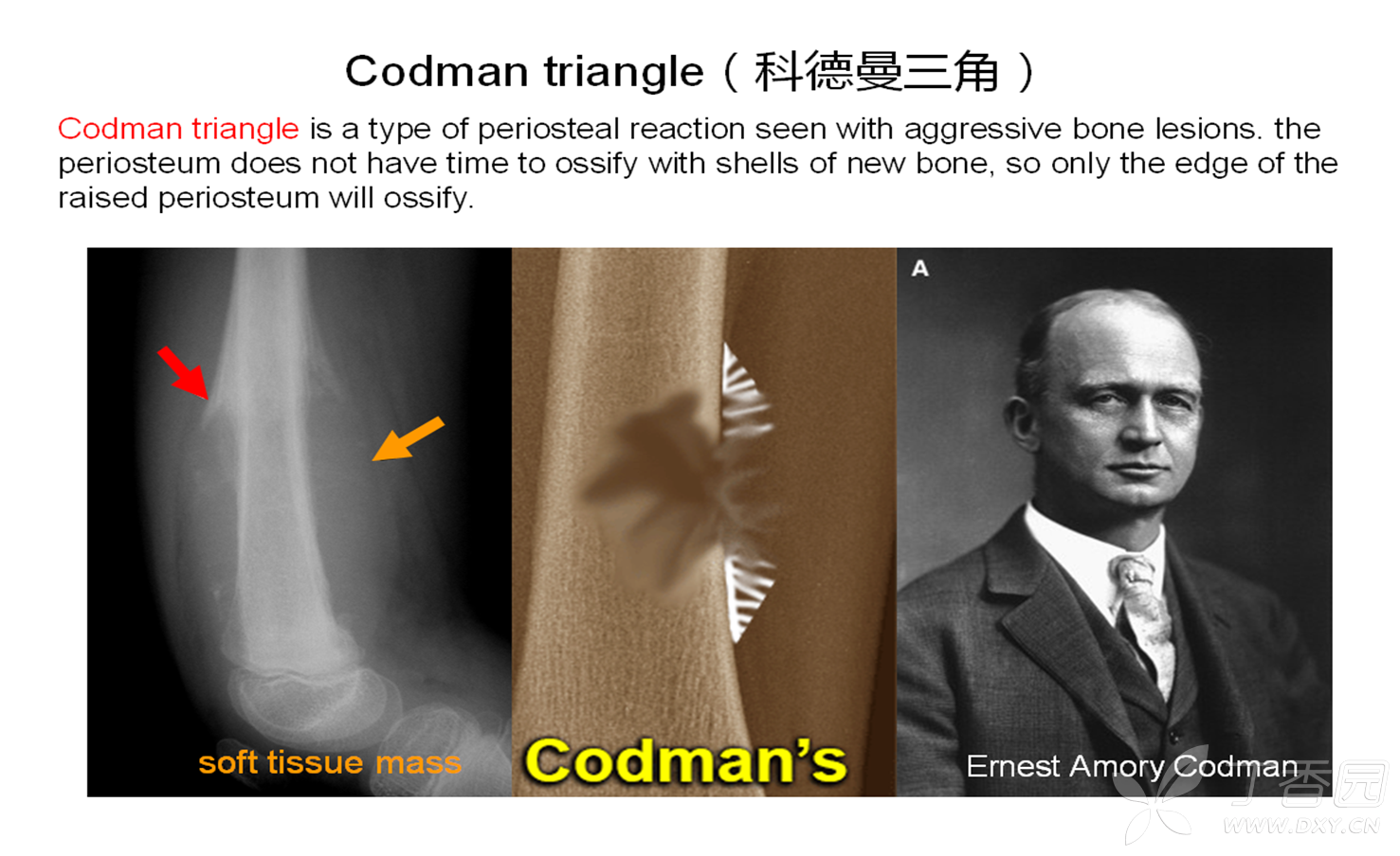 codman三角示意图图片-千图网