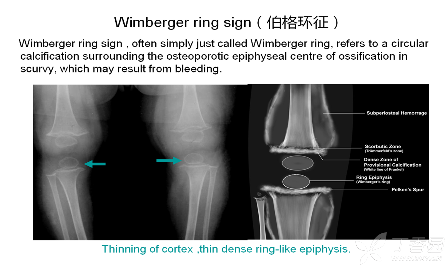 Wimberger ring sign（伯格环征） - 影像核医学 -丁香园论坛