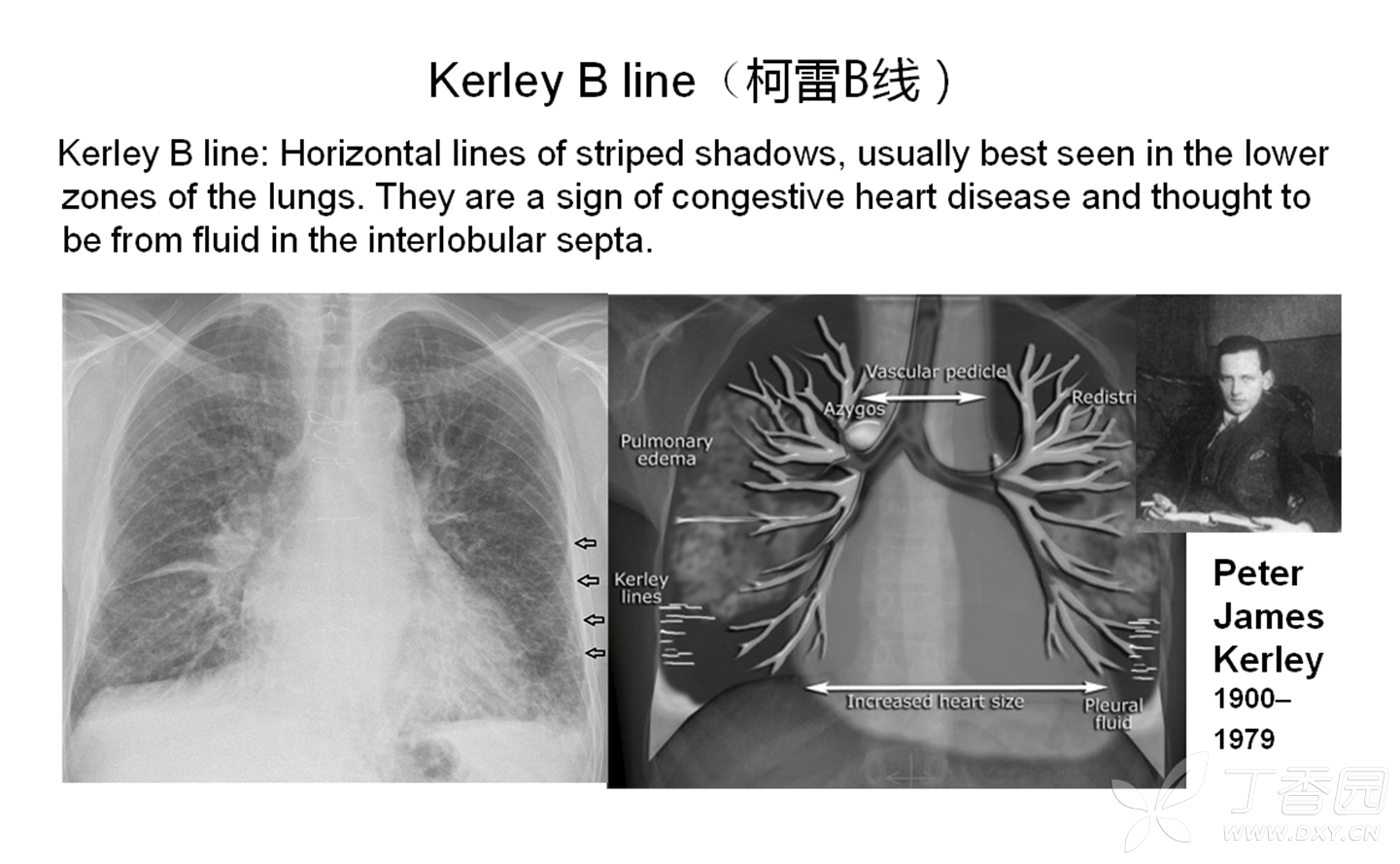 Kerley B line（柯雷B线） - 影像医学和核医学讨论版 -丁香园论坛