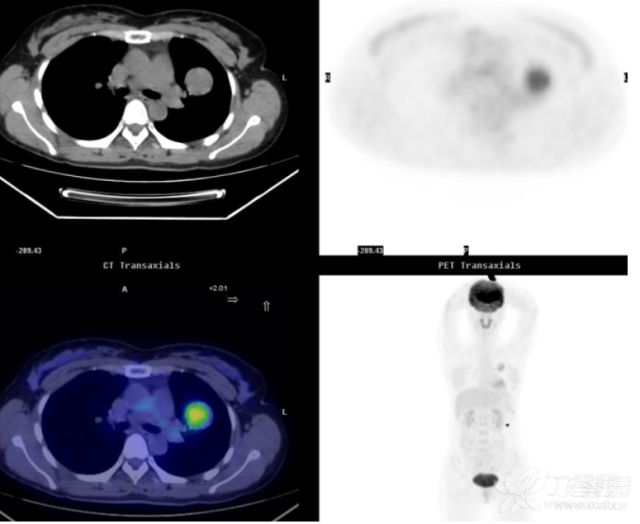 看图学PET/CT--浅谈PET/CT的应用 - 影像医学和核医学讨论版 -丁香园论坛