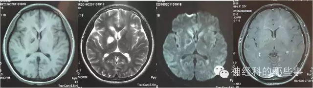 神经内科随笔（39）：了解头颅DWI上的环形改变