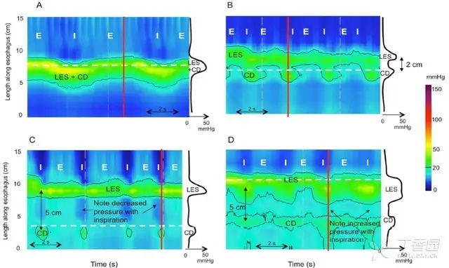食管测压，你会看吗？