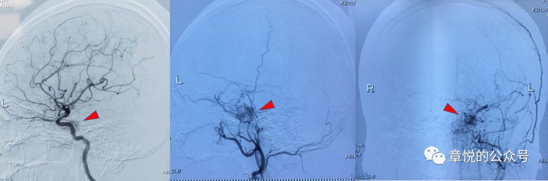 罗德西亚纷争之颈动脉海绵窦瘘