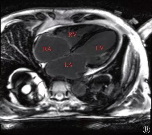 协和疑难︱第63例：临床表现乏力、憋气