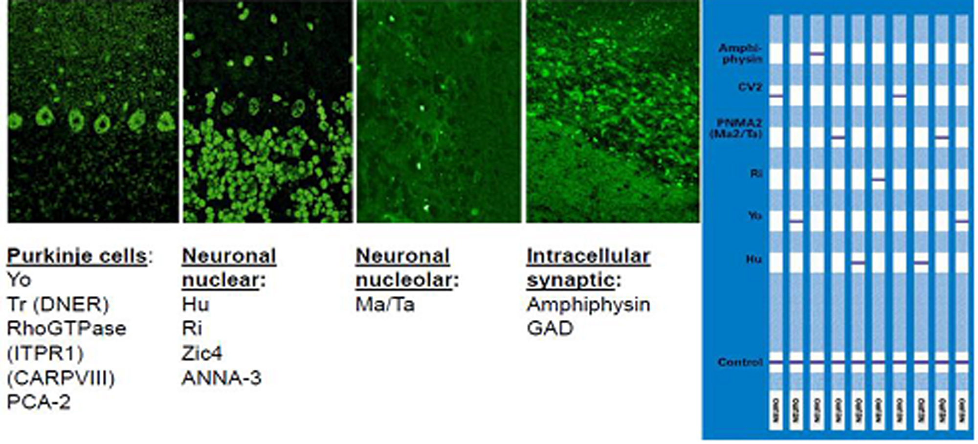 关鸿志教授：自身免疫性脑炎相关抗体检测进展