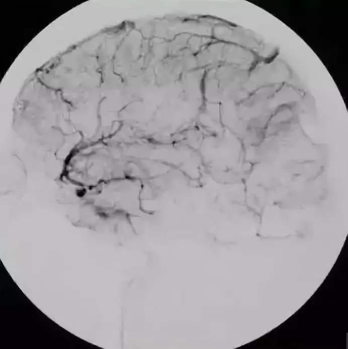 脑血管 DSA 不会看？这篇文章带你入门