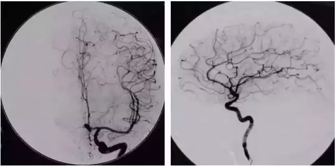 脑血管 DSA 不会看？这篇文章带你入门