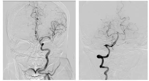 术说丨「防患未然」——球囊导引导管近端保护下的支架取栓术