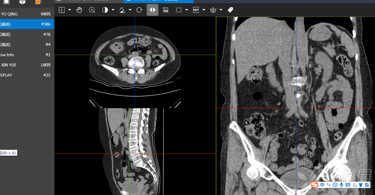 分享一个免费好用的DICOM看图软件：小赛看看 - 影像医学和核医学讨论版 -丁香园论坛