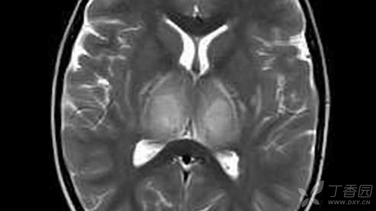 影像诊断挑战：惊厥昏迷的患儿的脑MRI - 影像医学和核医学讨论版 -丁香园论坛