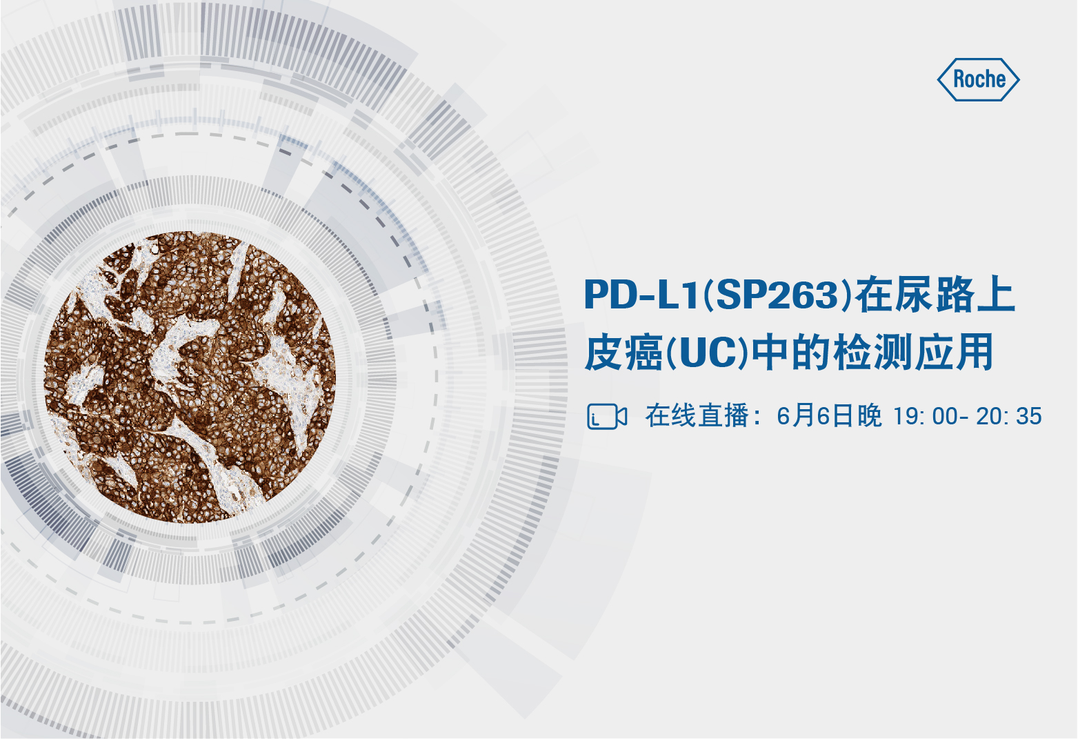PD-L1（SP263）在尿路上皮癌（UC）中的检测应用 - 丁香播咖