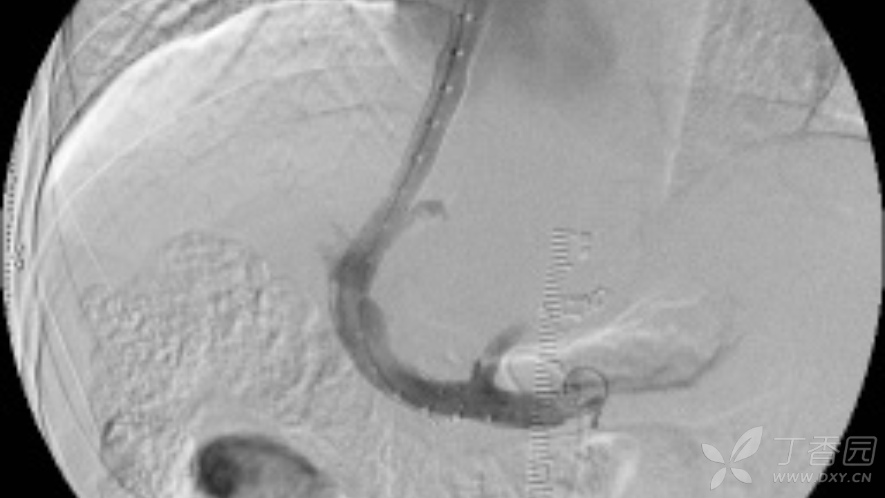 TIPS手术（RUPS-100操作）