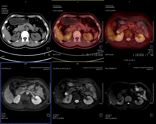 PET/CT-MR 增强异机融合在原发性肝癌诊断中的使用价值 － 丁香园