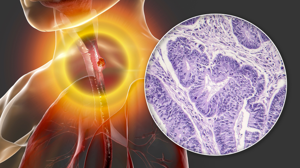 OS、PFS、DFS 有什么区别？一文搞懂 6 大肿瘤临床试验终点