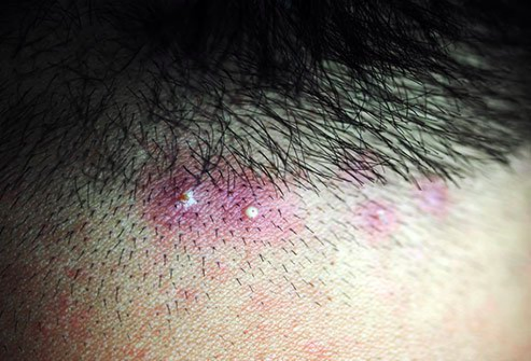 孕期头皮长疙瘩症状_病因_治疗方法_鉴别_专家咨询|丁香医生