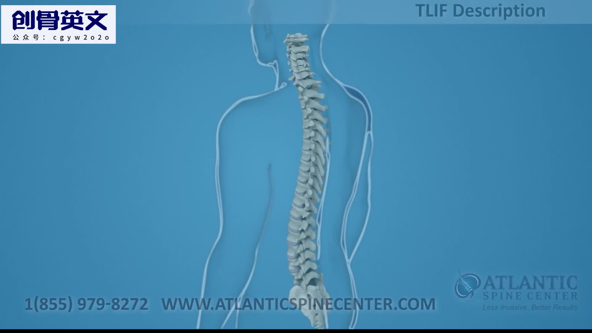 Transforaminal lumbar interbody fusion（TLIF）