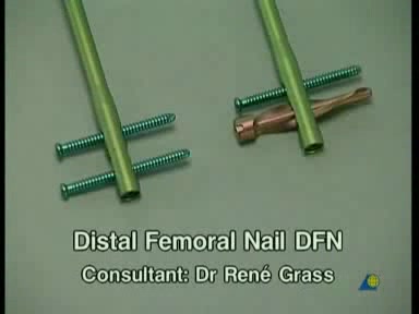 AO骨科手术教学视频全集-20200Distal Femoral Nail DFN - 丁香园论坛
