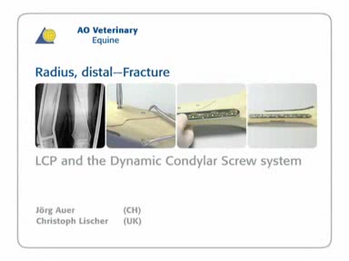 AO骨科手术教学视频全集-31087Radius, distal—fracture, LCP and the dynamic condyl ...