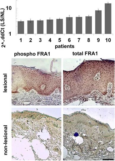 【Biorbyt文献】关于TNF alpha抗体：FRA1介导角质形成细胞的活化-对银屑病斑块发展的影响 - 企业动态 - 丁香通