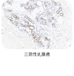 【IHC精准检测】——三阴性乳腺癌伴随诊断关键抗体：TROP-2 - 企业动态 - 丁香通