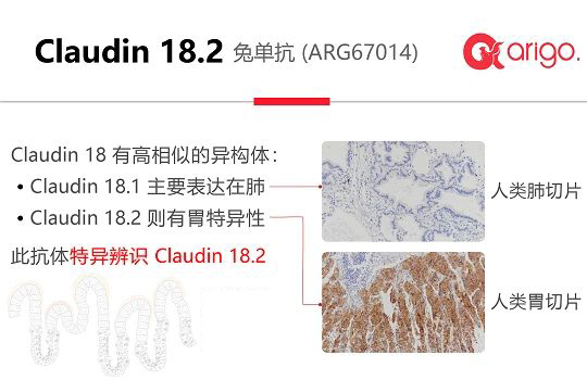 Claudin 18.2 CAR-T 疗法：抗胃癌 & 攻克实体瘤双亮点 - 企业动态 - 丁香通