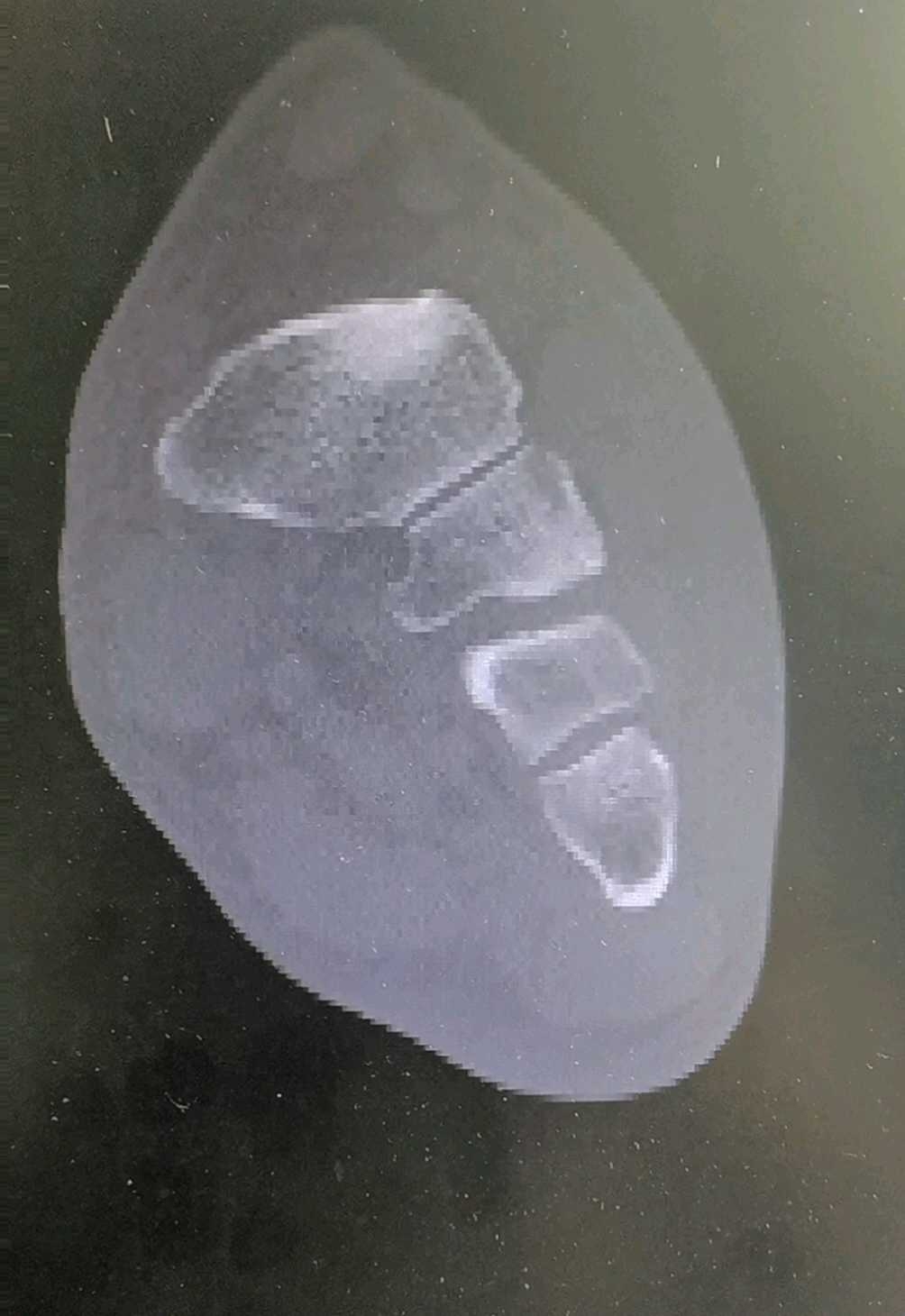 第86例，今天在龙承老师指导下，完成了一例跟骨Sanders IIA，第一次尝试这种布钉方式