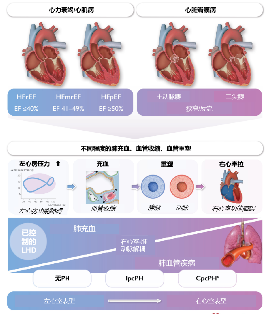 左心疾病所致肺动脉高压