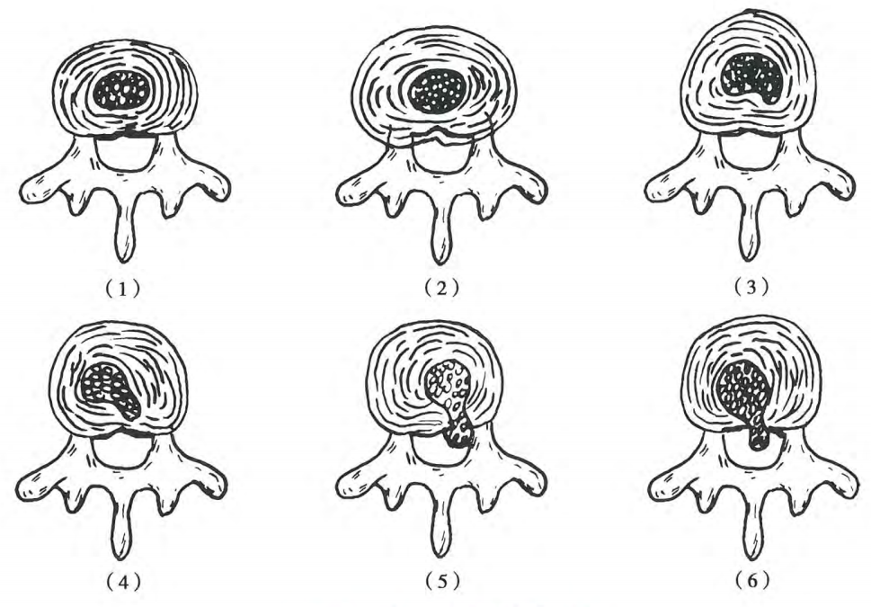 腰椎间盘突出症