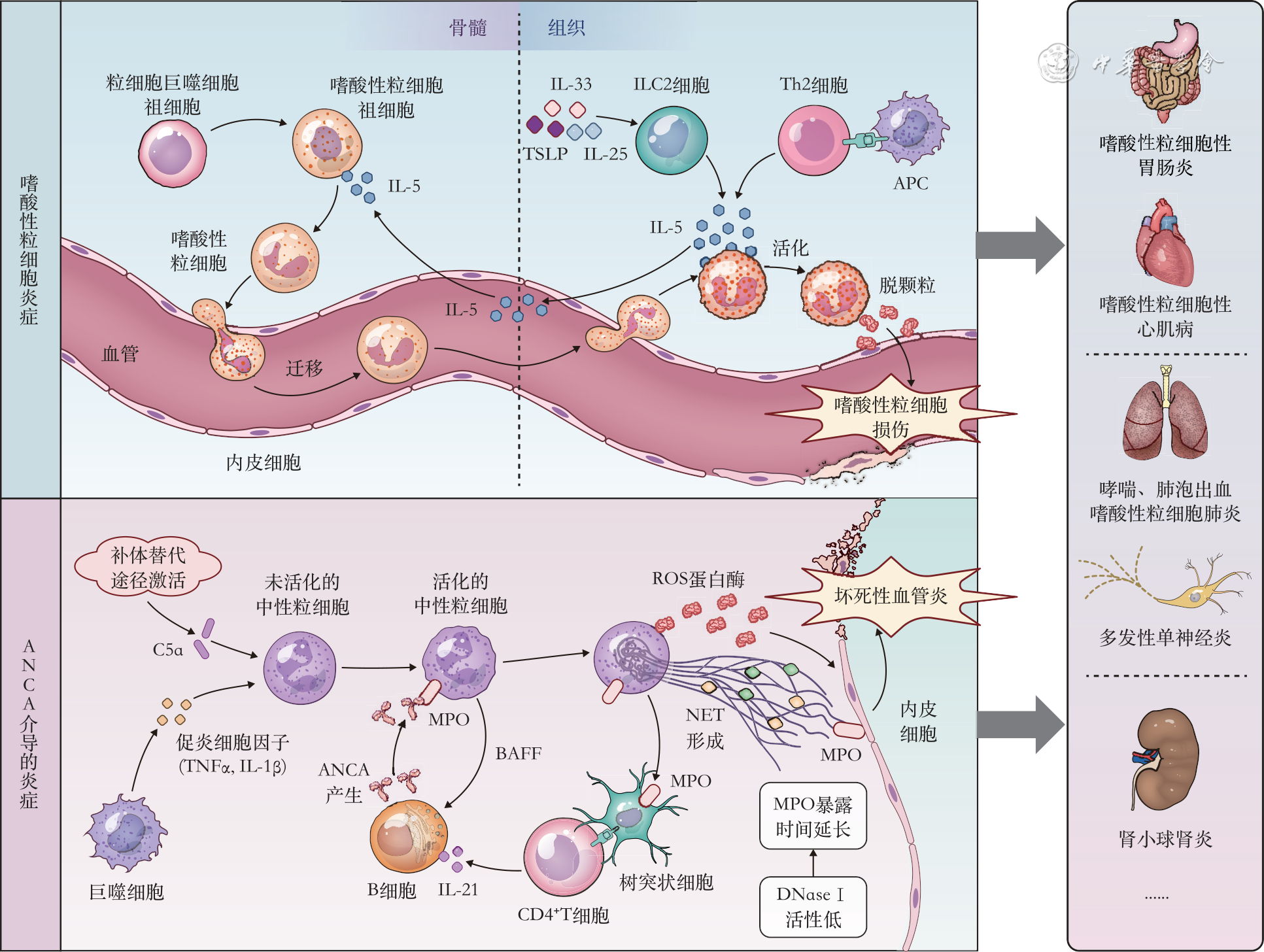 嗜酸性肉芽肿性多血管炎