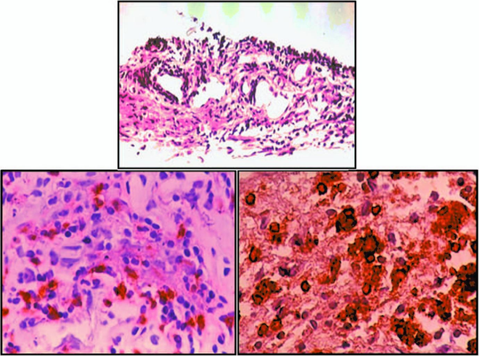 视网膜静脉周围炎