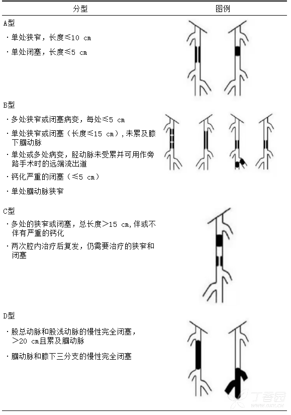 下肢动脉硬化闭塞症